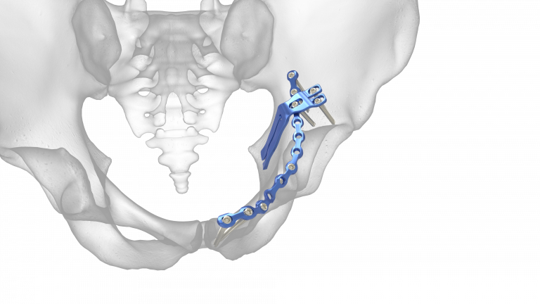 Anterior Brim & Quadrilateral Surface Plate | Acumed Anterior Brim & Quadrilateral Surface Plate | Acumed